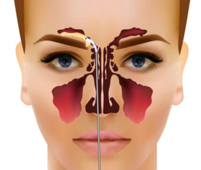 Balloon Sinuplasty Tampa FL Nasal Sinus Services balloon-sinuplasty-tampa-fl-nasal-sinus-services