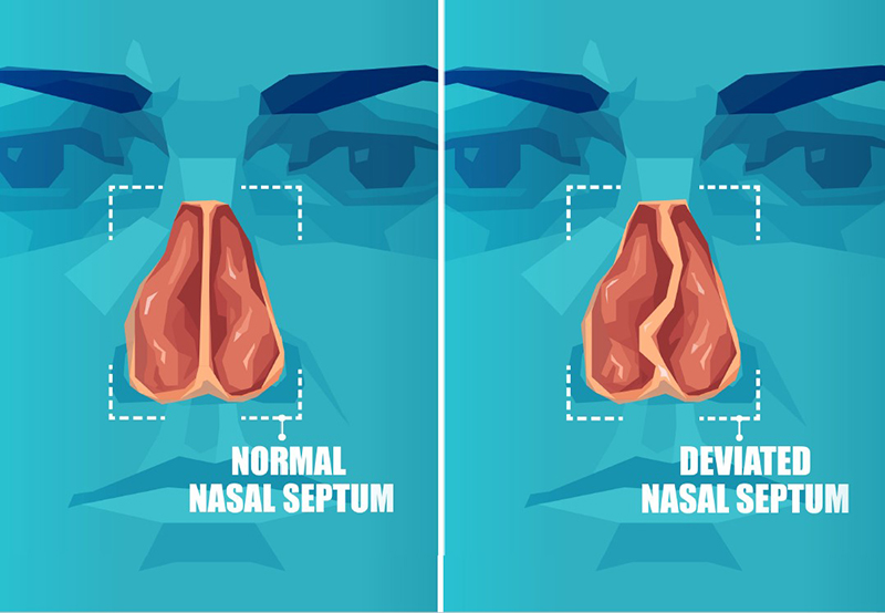 Deviated septum Tampa FL, Nasal & Sinus Services