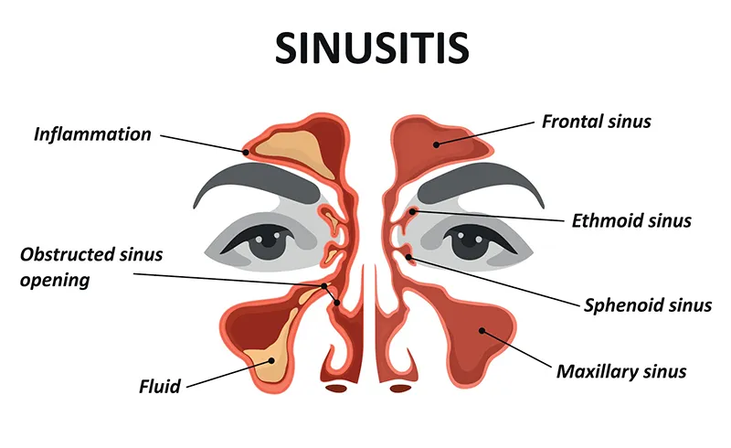 Sinusitis Tampa FL Nasal Sinus Services