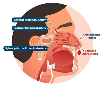 Nosebleed (Epistaxis) Tampa FL, Nasal & Sinus Services