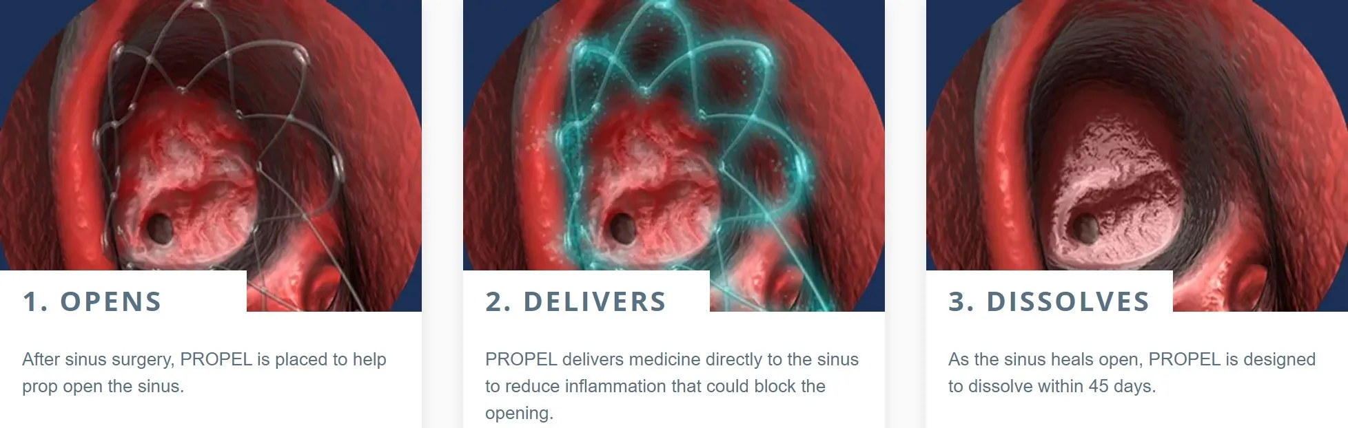 PROPEL® Sinus Stent Tampa FL, Nasal & Sinus Services