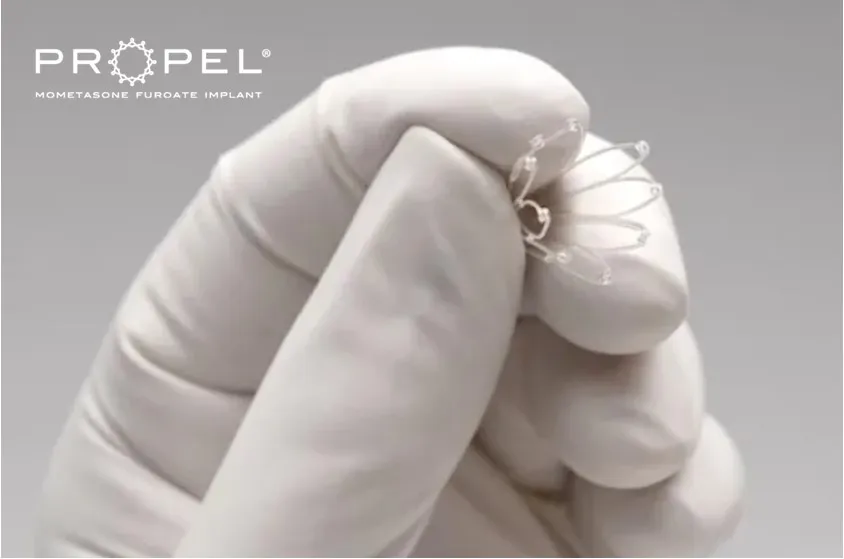 PROPEL® Sinus Stent Tampa FL, Nasal & Sinus Services